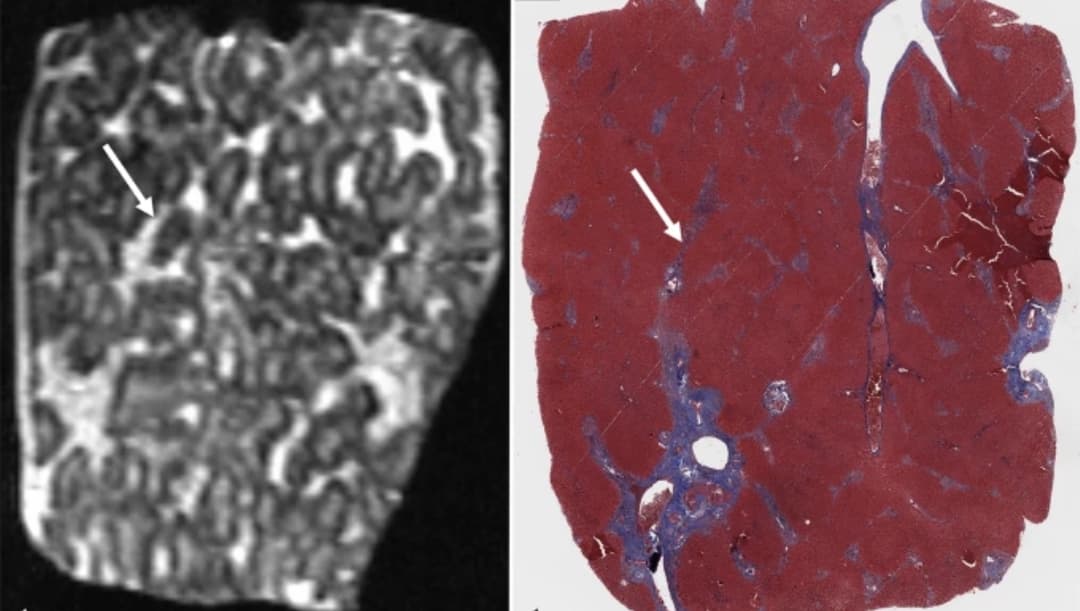 Le référentiel LI-RADS d'échographie diagnostique du CHC en