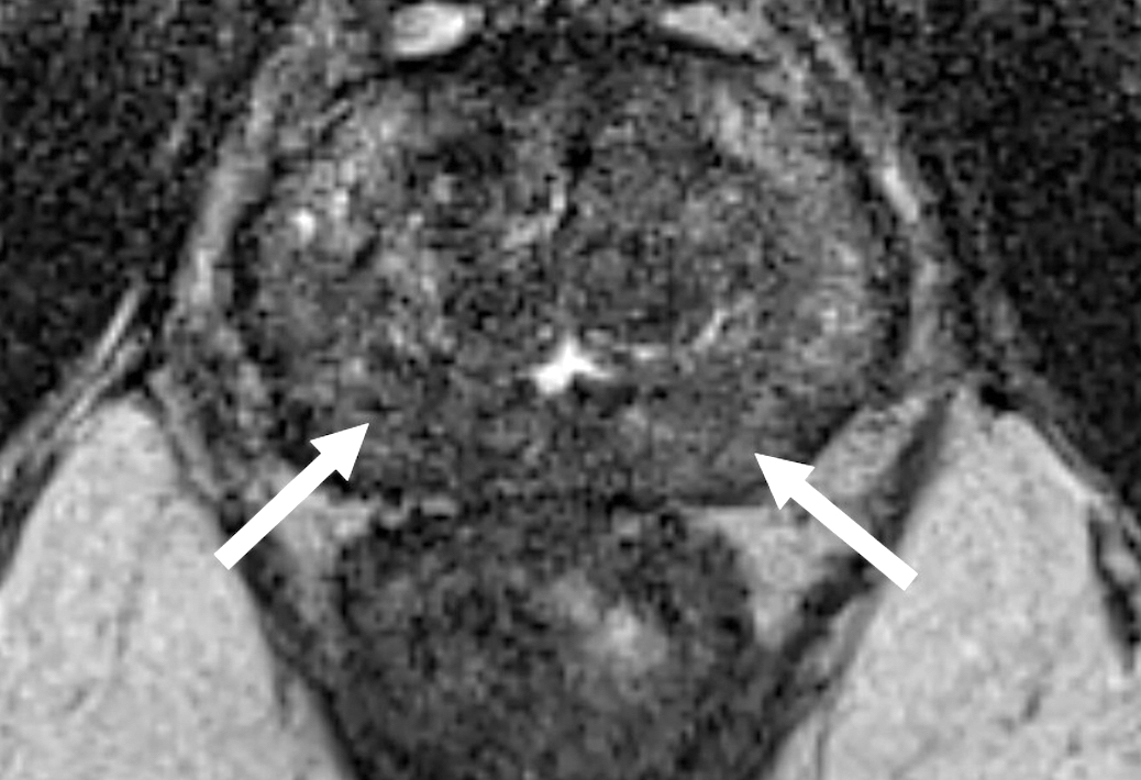 Quand et comment utiliser PI-RR et PI-RADS après traitement